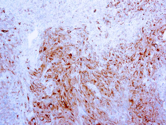 MART-1/Melan-A Antibody – Diagnostic BioSystems (DBS)