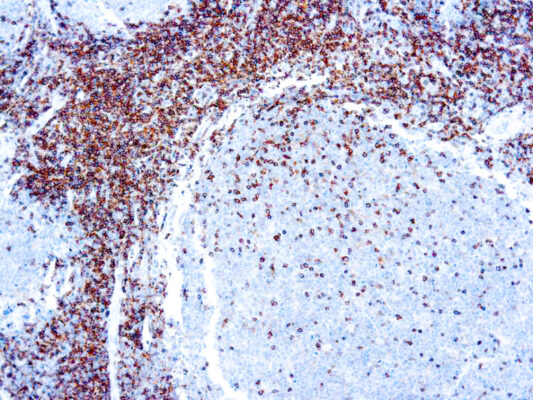 CD45 LCA - Diagnostic BioSystems -Advanced Tissue Diagnostics & Trusted ...
